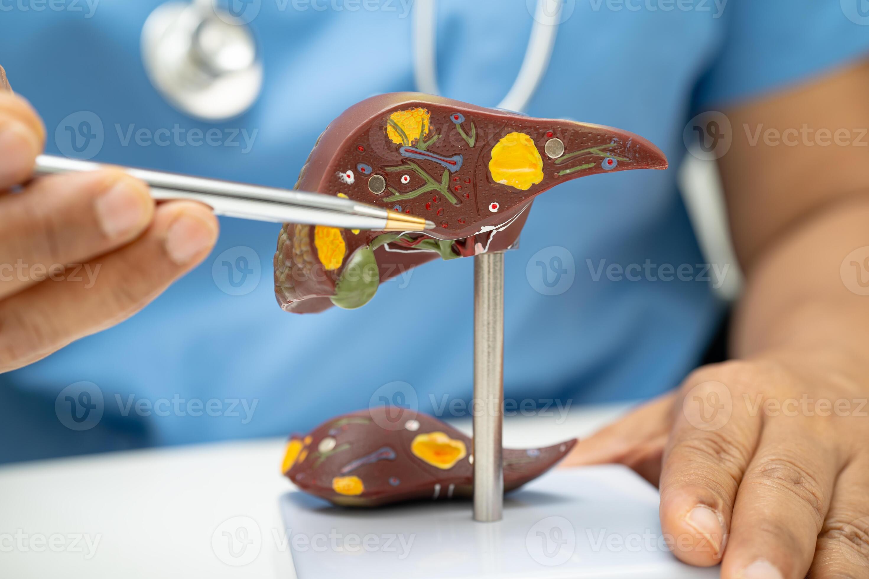Cirrhosis, Liver cancer, fatty liver, Asian doctor with liver human ... Cirrhosis, Liver cancer, fatty liver, Asian doctor with liver human ...