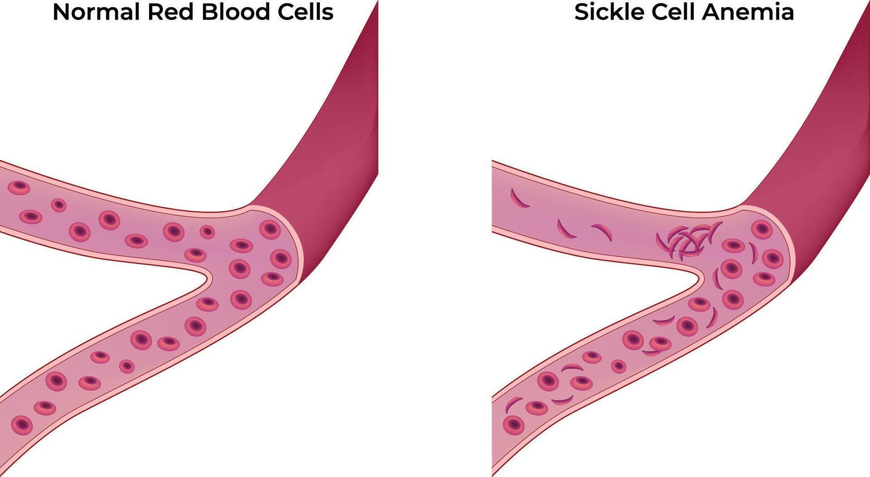 Comparison of Normal Red Blood Cells and Sickle Cell Anemia Illustration 58100905 Vector Art at ...