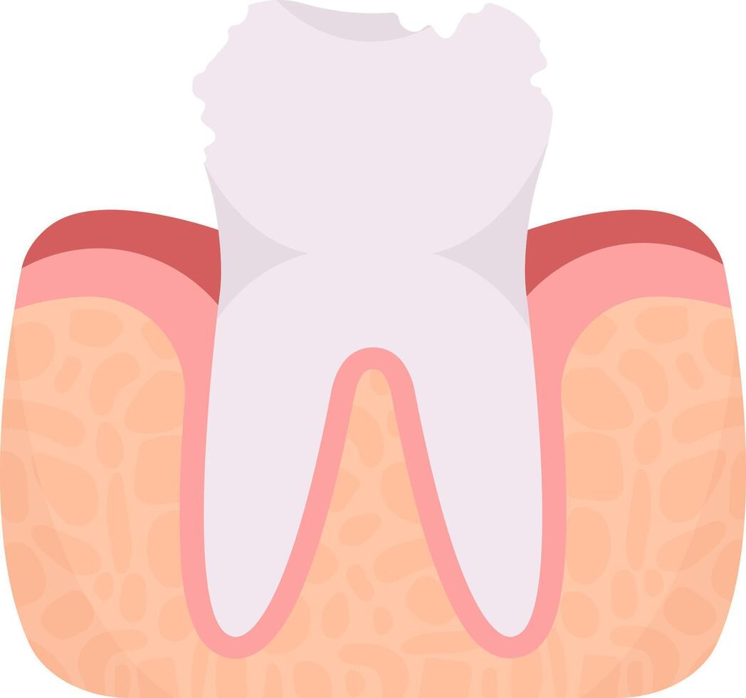Decayed Tooth Problem 68535595 Vector Art at Vecteezy