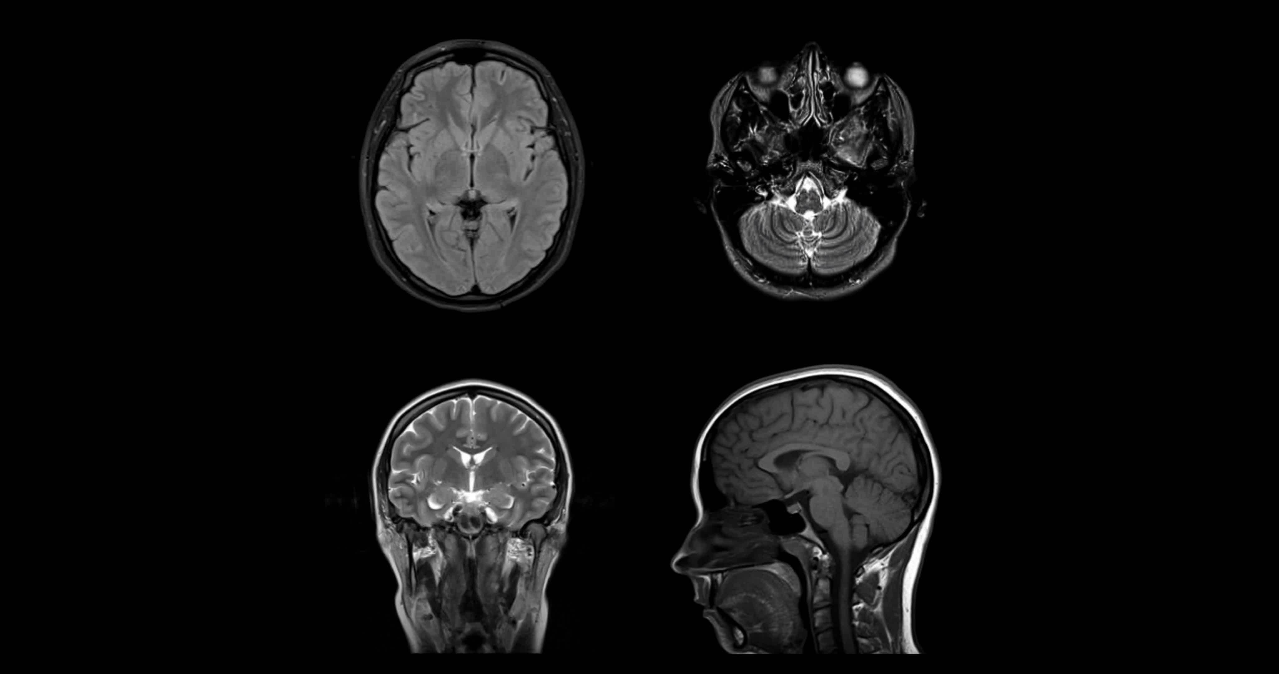 Brain Top View Mri
