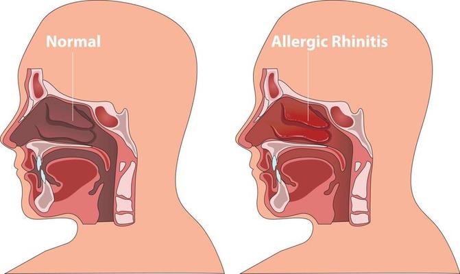 Sinusitis Vectores, Iconos, Gráficos y Fondos para Descargar Gratis Sinusitis Vectores, Iconos, Gráficos y Fondos para Descargar Gratis