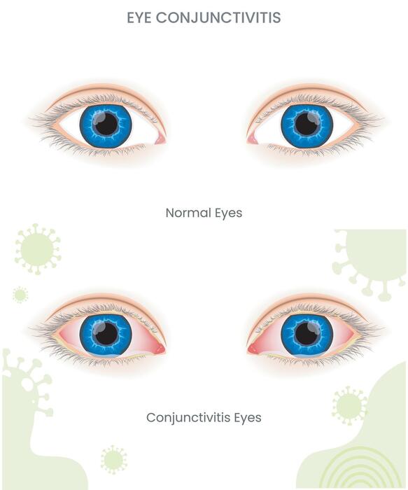 Eye Membrane Swelling