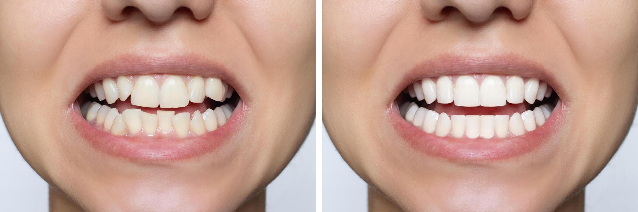 Before And After Teeth Stock Photos, Images and Backgrounds for Free ...