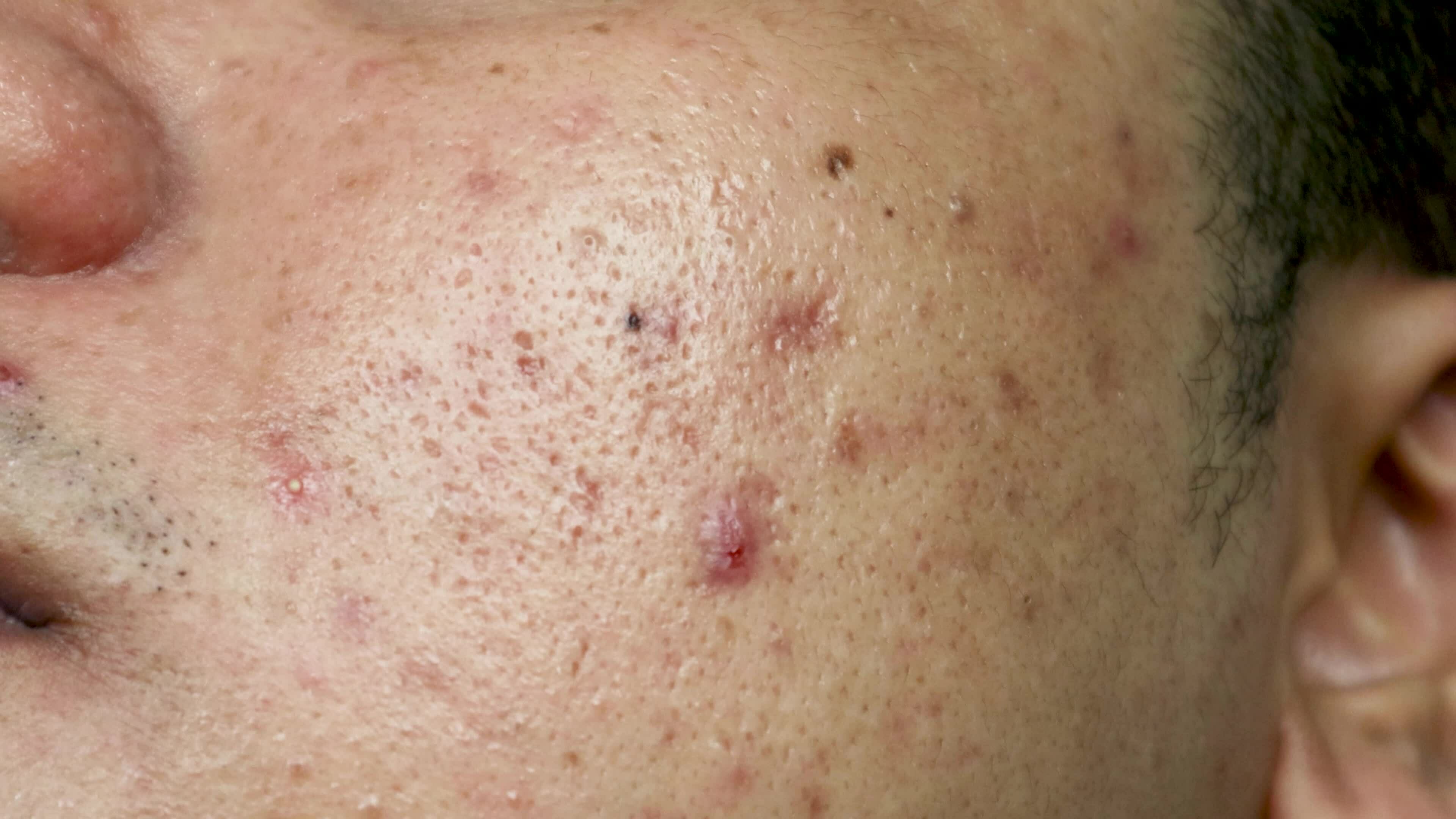 pelle i problemi. problema di infiammato acne su il viso. infiammato ... pelle i problemi. problema di infiammato acne su il viso. infiammato ...